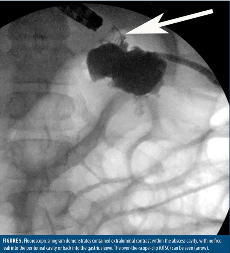 Nasogastric Tube Perforation Masquerading as a Delayed Gastric Sleeve ...