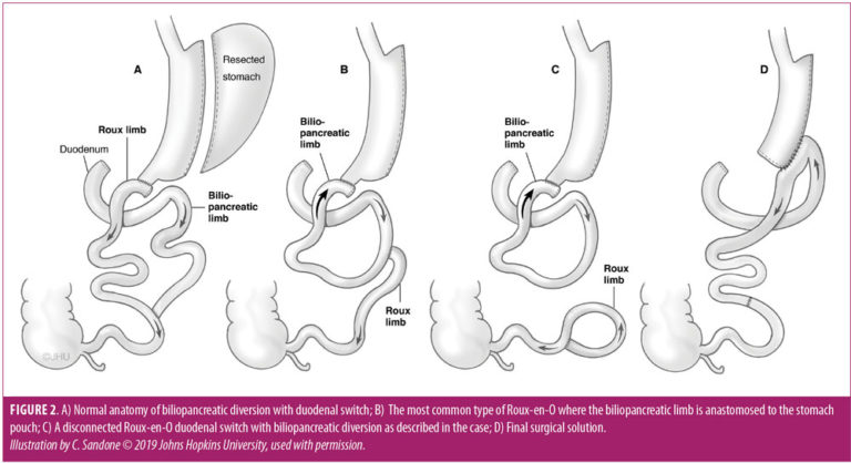 Roux-en-O after Duodenal Switch: A Case Report : Bariatric Times Roux-en-O after Duodenal Switch: A Case Report : Bariatric Times