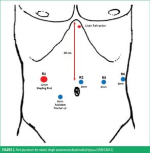 Robotic Single-Anastomosis Duodenoileal (SADI) Bypass After Sleeve ...