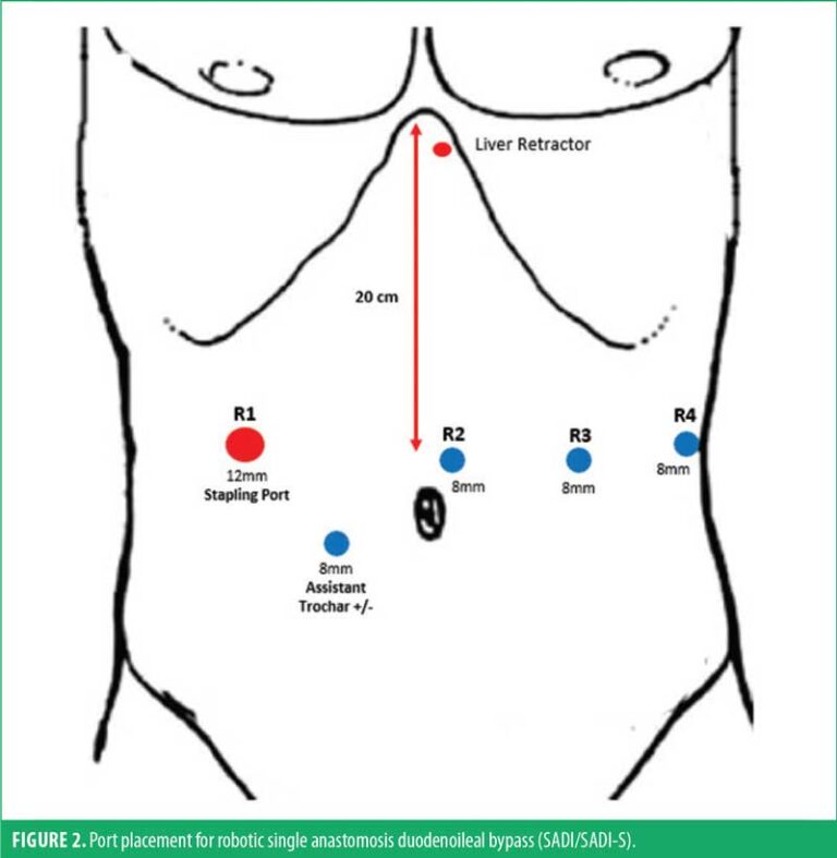 Robotic Single-Anastomosis Duodenoileal (SADI) Bypass After Sleeve ...