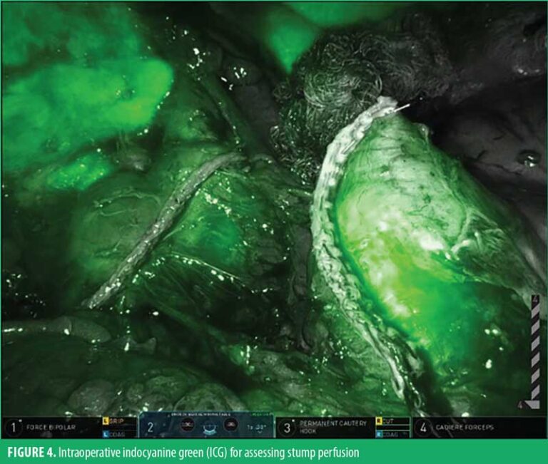 Robotic Single-Anastomosis Duodenoileal (SADI) Bypass After Sleeve ...